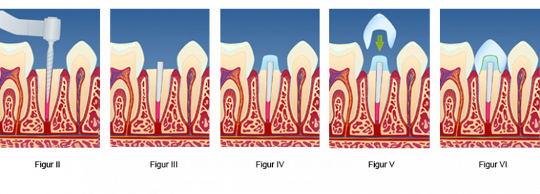 Stift – Krone - Bekkestua Tannmedisin